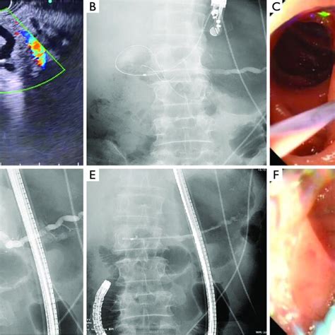 The Procedure Of Single Balloon Enteroscopy Assisted Endoscopic