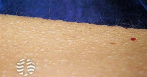 linear iga bullous disease image