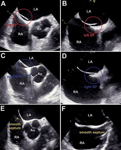 Mid Esophageal Short Axis And Bicaval Views Of Interatrial Septum In