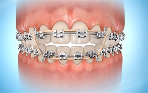Types Of Orthodontic Elastics And Why You Need To Wear Them