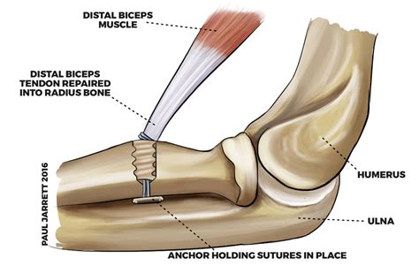 Distal Bicep Tendon Pain