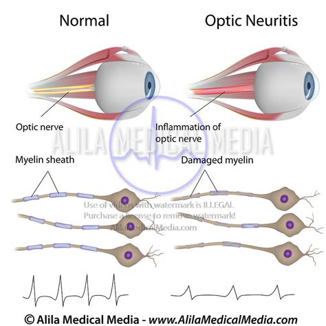 Alila Medical Media Optic Neuritis Medical Illustration