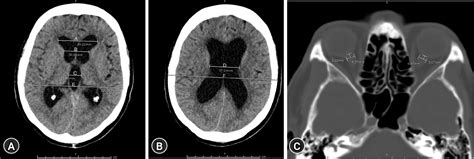 figure 2 from comparison of intracranial pressure prediction in
