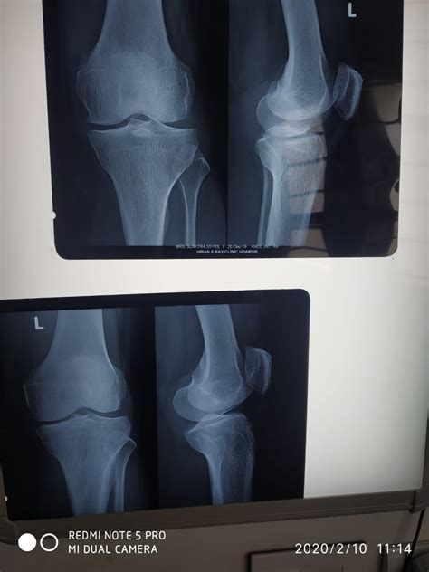 Xrays Forecast Progressive Knee Osteoarthritis