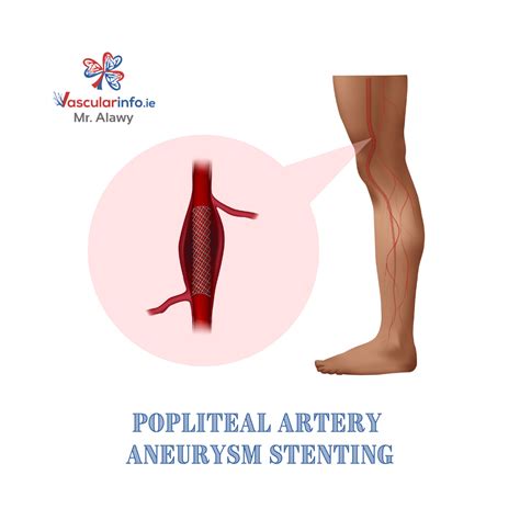 Popliteal Artery Aneurysm Vascular Info