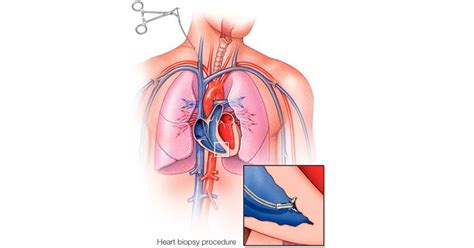 Heart Biopsy Meds Wiki
