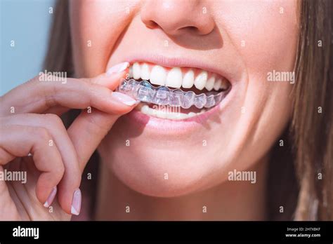 Woman With Perfect Smile Wearing Invisible Dental Aligners For Dental
