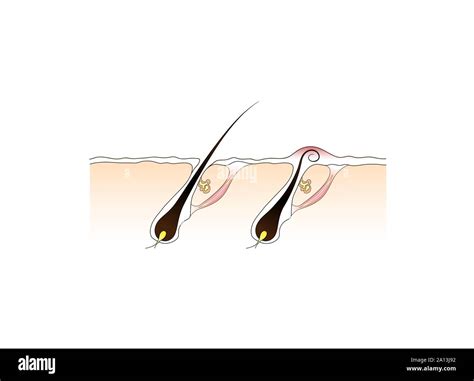 Hair Growth Ingrown Hair Skin Inflammation Scheme Hair Follicle