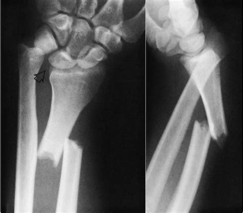 Monteggia Fracture Galeazzi Fracture