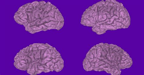Neuroprosthetics Doctors Decode Human Speech From Brain Signals