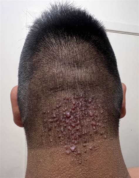 My Success Story With Folliculitis R Folliculitis