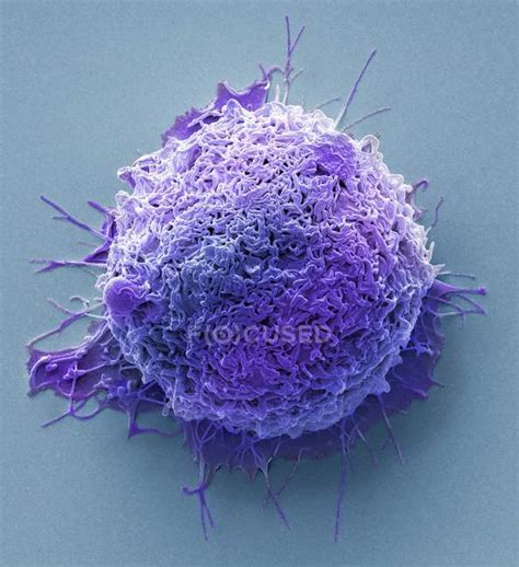 Coloured Scanning Electron Micrograph Of Cancer Cell From Human Colon