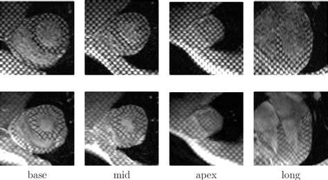 Figure 1 From Cardiac Motion Estimation By Joint Alignment Of Tagged Mri Sequences Semantic