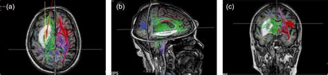 Dti Diffusion Tensor Imaging Shows The Spatial Relationships Between Download Scientific
