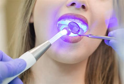 Dentist Doing Procedure With Dental Curing Uv Light In Clinic Stock