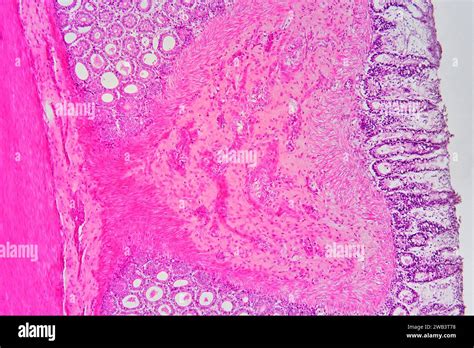 Human Vermiform Appendix Cross Section Showing Left To Right