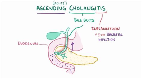 Ascending Cholangitis Video Anatomy Definition Osmosis