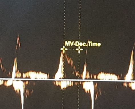What Is The Relationship Between Left Atrial Size And Mitral “e” Decceleration Time Dr S
