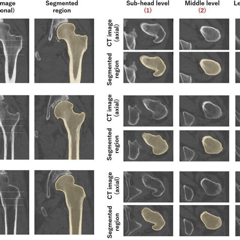 Segmentation Of The Left Femur From CT Images Using A Deep