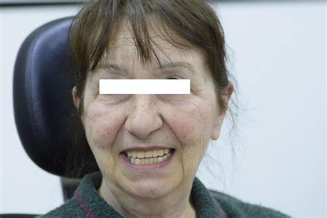 Силиконови зъбни протези 3 Дентален център Ес Би Си