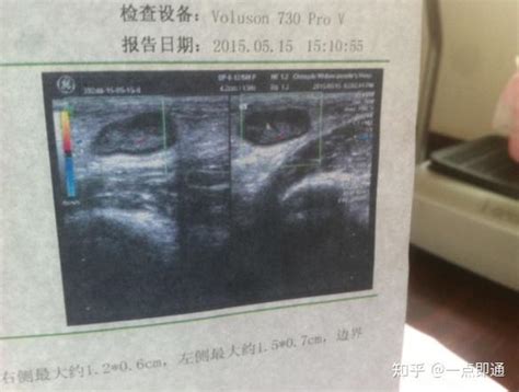 提醒：女性出现“1大1臭”，劝你早查hpv，或是宫颈癌暗示 知乎