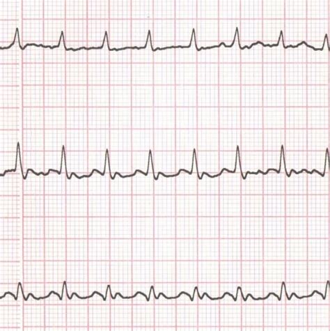 Atrial Flutter Life In The Fast Lane Ecg Library