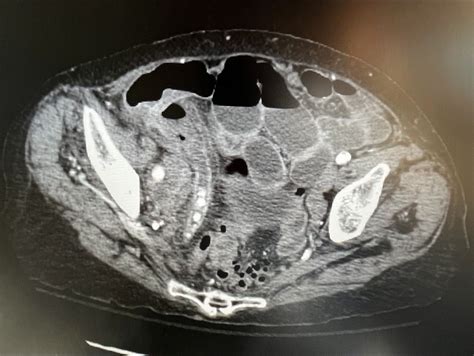 Appendicolith And Non Operative Management Of Appendicitis Farshad