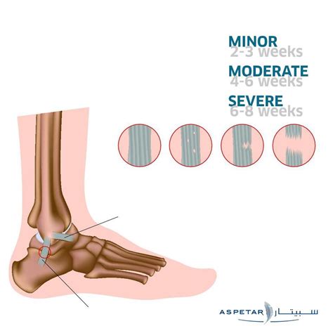 Severity Of Ankle Sprain Timeline Sprained Ankle Fracture Healing