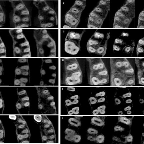 Canal Configurations Observed In The Db Root A Vertucci Type I 1 1