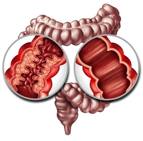Occlusion Intestinale Causes Symptômes Et Traitements Appropriés