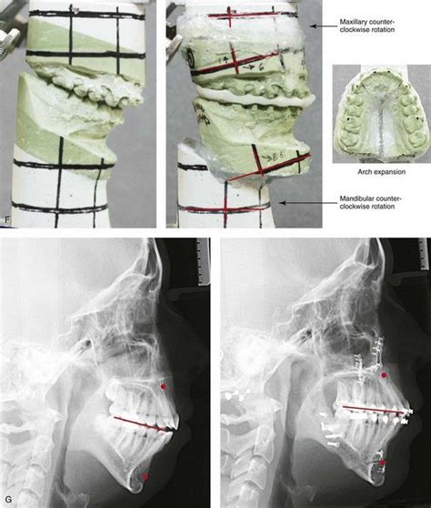 21 Long Face Growth Patterns Maxillary Vertical Excess With