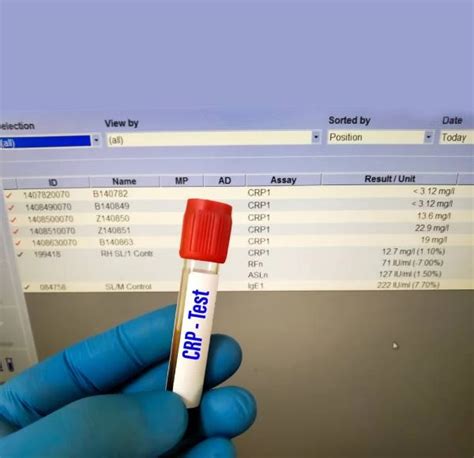 Crp Blood Test Know The Causes Symptoms And Normal Ranges Of Crp