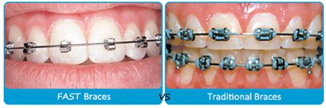 Fast Braces Vs Traditional Braces