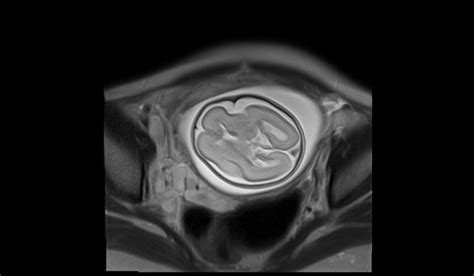 Fetal Brain Mri Axial Localiser Images Mrimaster