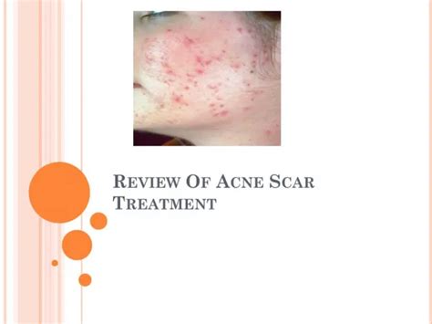 Ppt Acne Scar Treatment Powerpoint Presentation Free Download Id