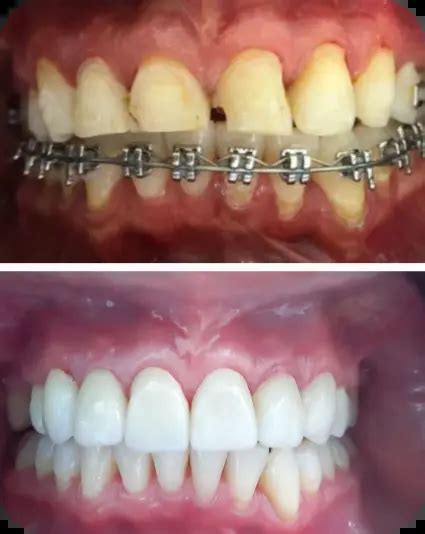 Diseño de Sonrisa Clínica Estética Sanura en Quito Ecuador
