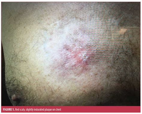 Sclerodermiform Lupus Erythematosus A Series Of Five Patients Jcad