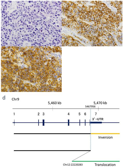 Histology And Genomic Features Of Neoplastic Pd L Extranodal Dlbcl