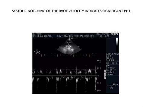 Pulmonary Hypertension Echo Pptx