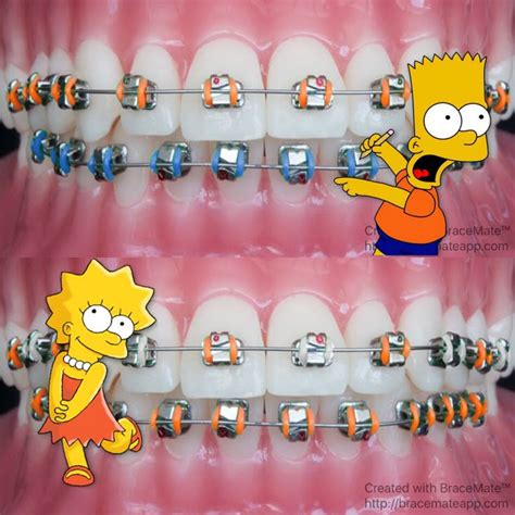 Thesimpsons Bart Lisa Braces Orthodontist Orthodontics