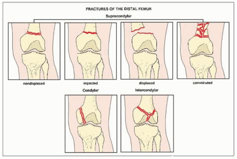 Intercondylar Extension Analysis Of Gender Differences In The