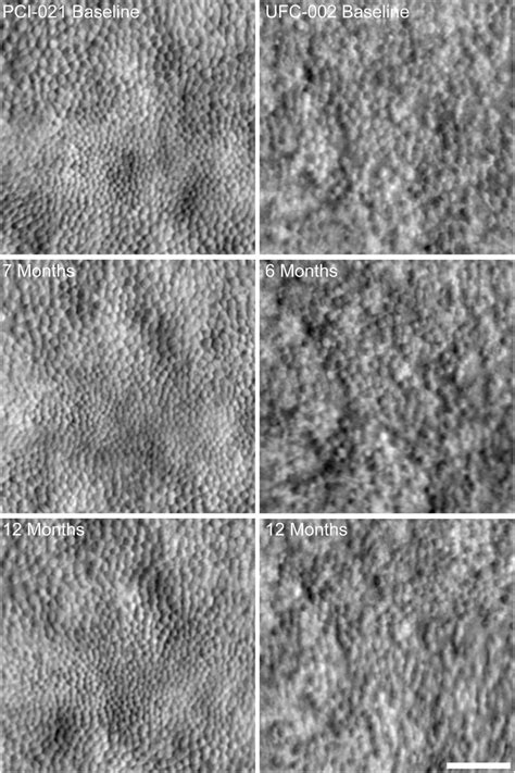 A Larger Field Image Of The Foveal Cone Mosaic Of Subjects Pci 021 And
