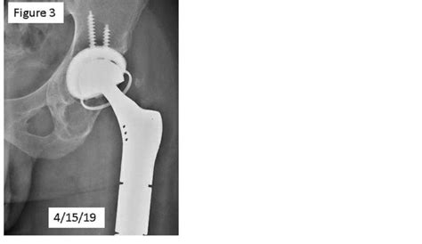 Sclerosis Of The Lucent Lesion After 1 Year Of Propranolol Download