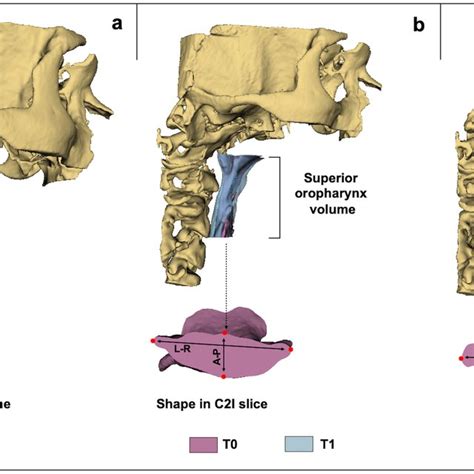 Upper Airway Linear Measurements In T0 And Volumetric Measurements Download Scientific