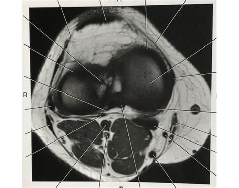 Axial T1 Mri R Knee Quiz