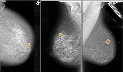 the visual assessment of breast tumor segmentation using our