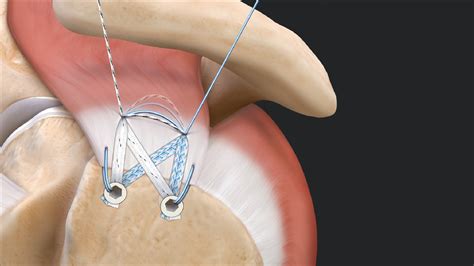Arthrex Knotless SwiveLock Suture Anchor