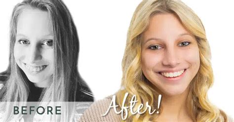 Before And After Braces Face Shape — Shoe Orthodontics Hanover Pa