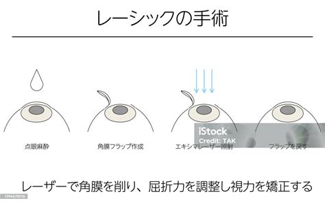 일러스트레이션 라식 시력 교정 메디컬 일러스트레이션 각막에 대한 스톡 벡터 아트 및 기타 이미지 각막 개선 건강 진단