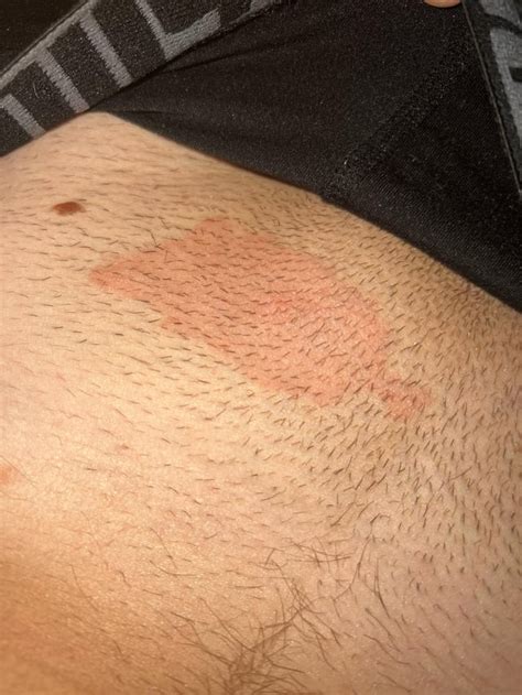 Rash On Groin Rdermatologyquestions